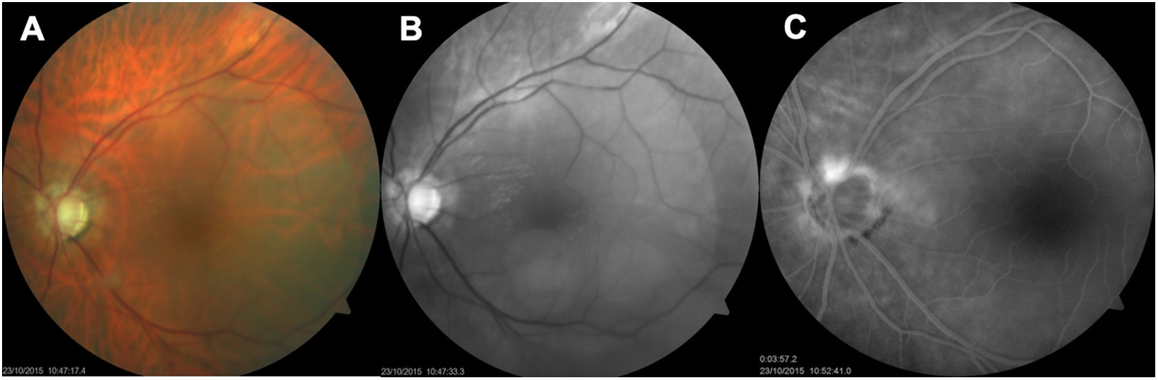 Tratamiento combinado de la maculopatía por foseta papilar secundaria a ...