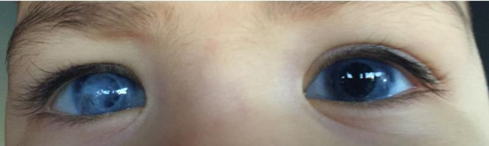 Experiencia a largo plazo de pacientes con anomalía de Peters ...