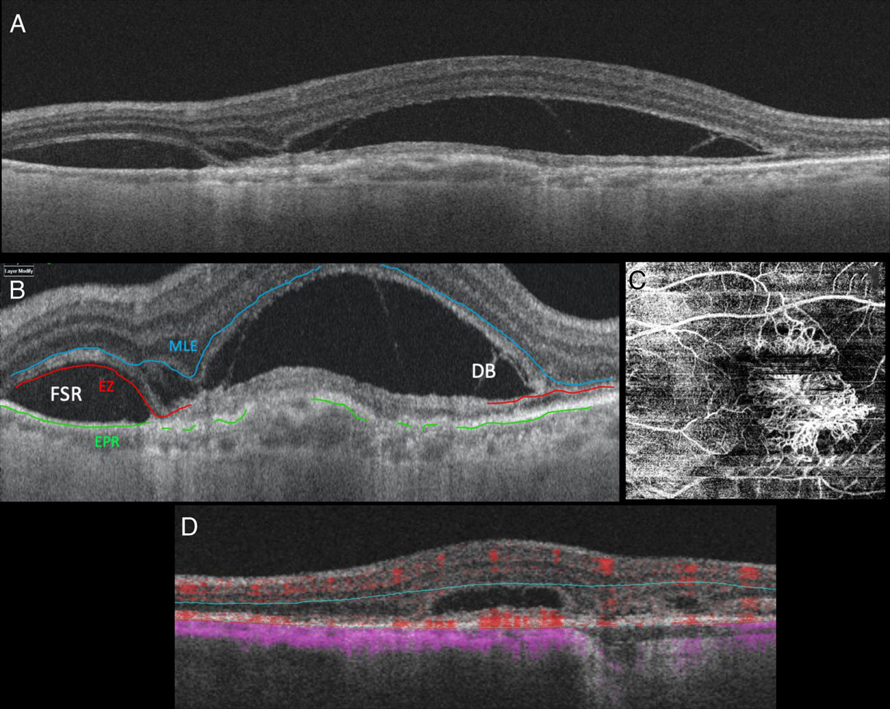 Desprendimiento bacilar en degeneración macular asociada a la edad ...