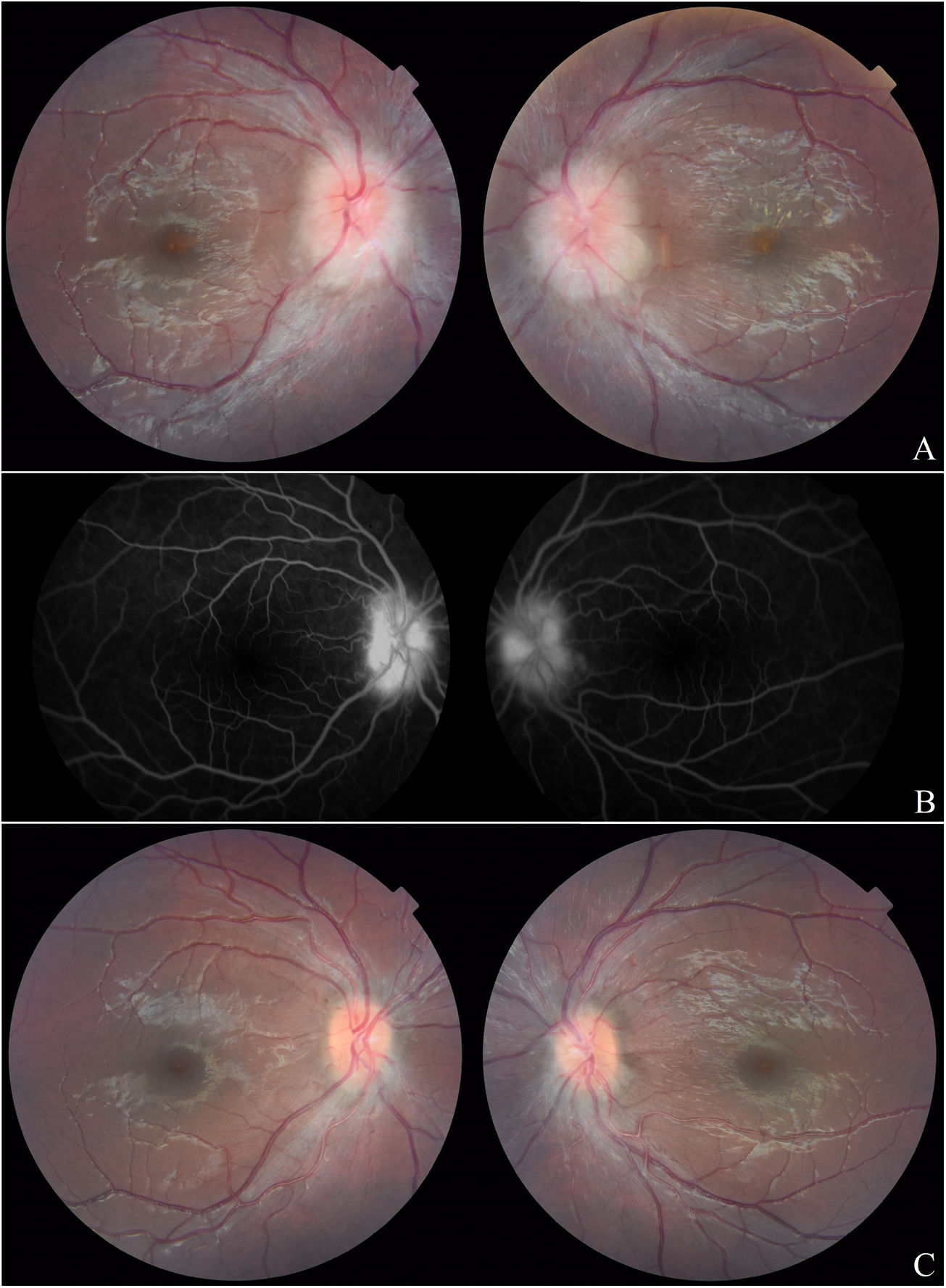 Neurorretinitis bilateral y nefritis lúpica membranosa: dos ...