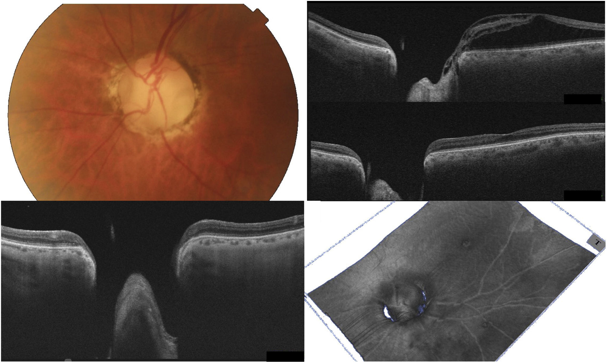 Doble foseta óptica. Resolución espontánea de la maculopatía asociada ...