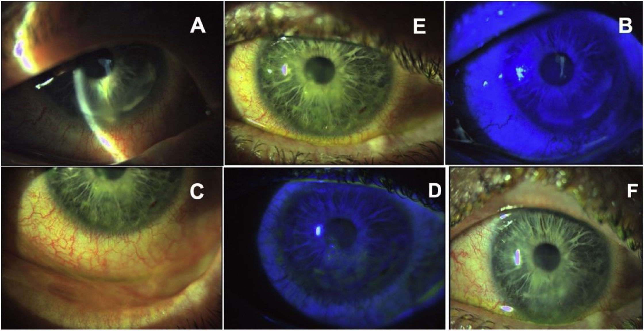 Afectación ocular secundaria a la infección por Monkeypox virus ...