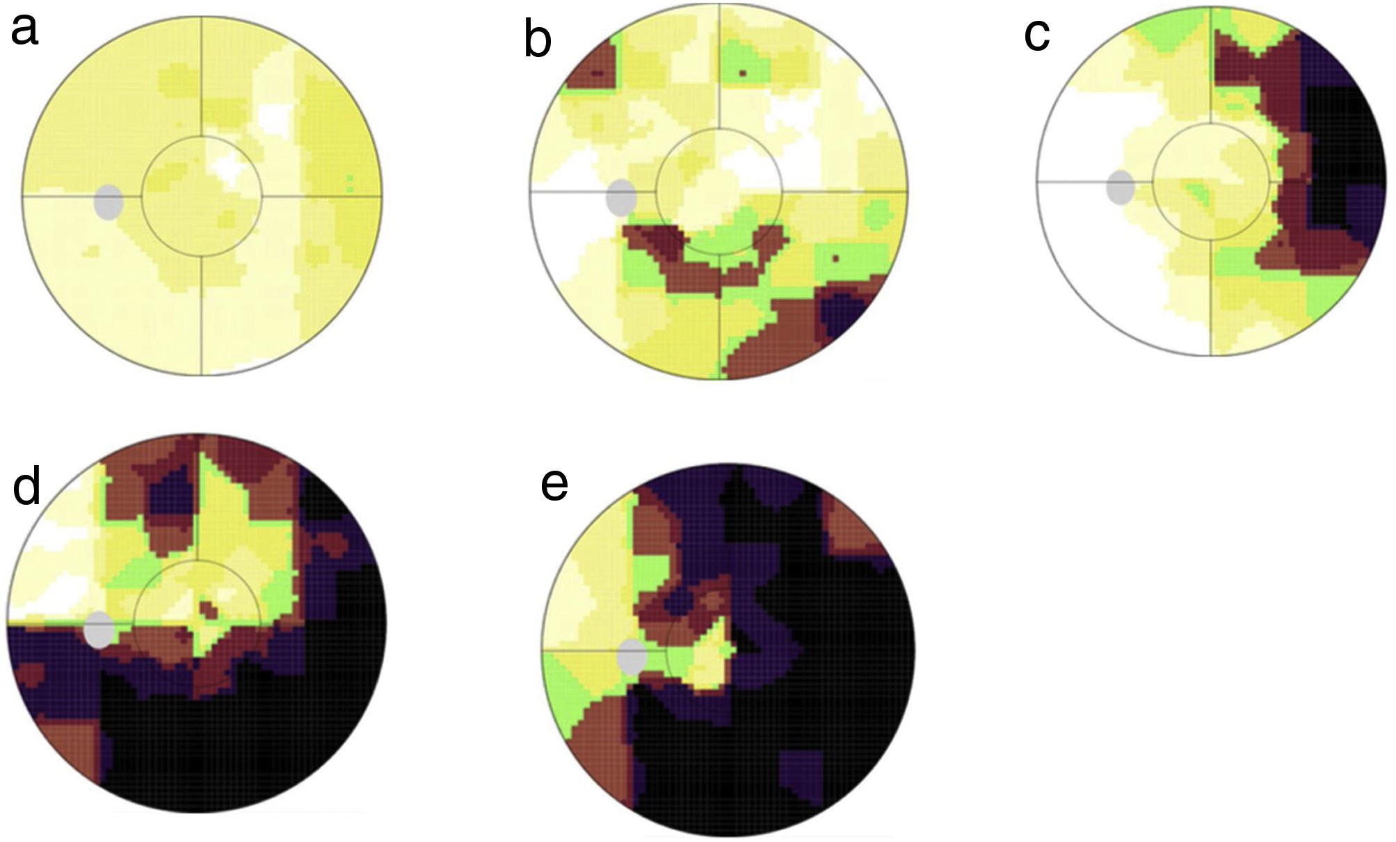 Detección y caracterización de defectos del campo visual mediante perimetría Octopus en glaucoma ...