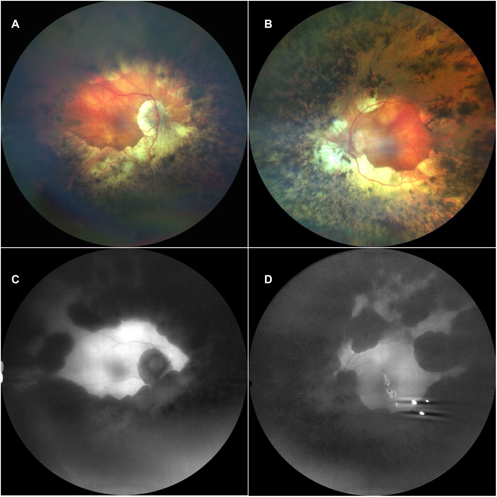 Atrofia girata de la coroides y la retina: actualización en diagnóstico ...