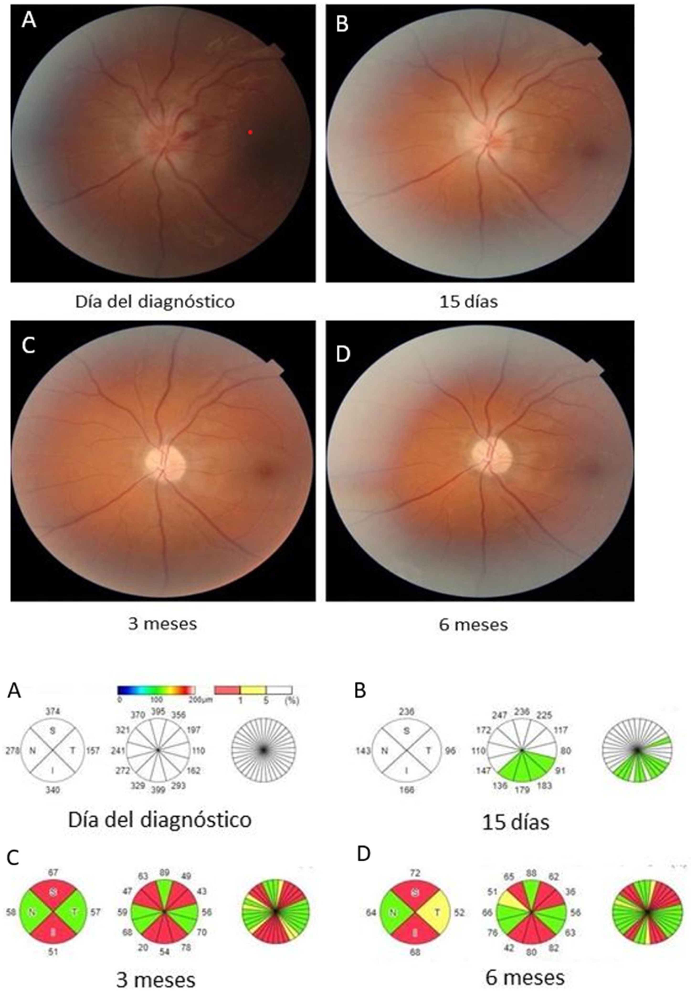 Neuropatía óptica isquémica anterior no arterítica como única ...