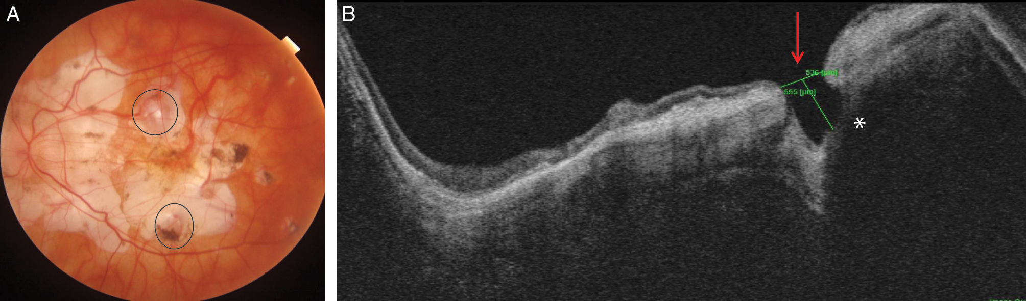 Foseta macular miópica con dehiscencia escleral en paciente con miopía ...