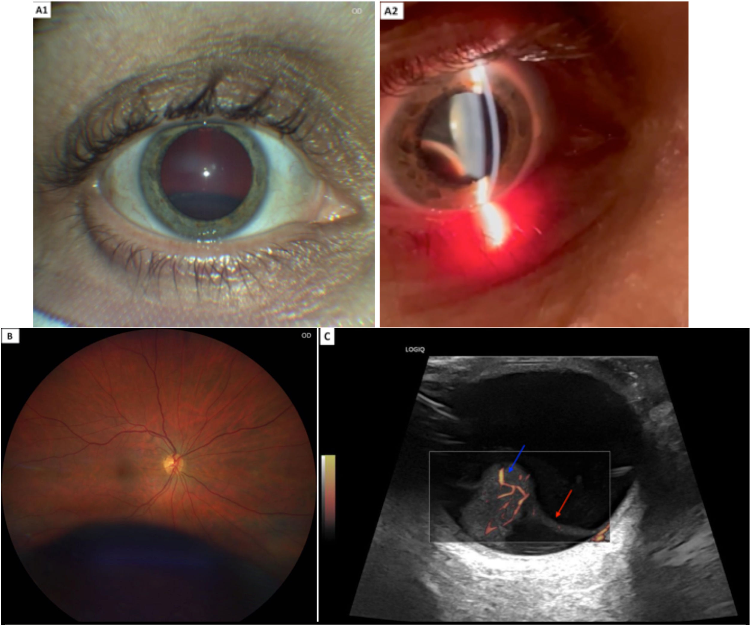 Melanoma de cuerpo ciliar: imagen multimodal | Archivos de la Sociedad ...