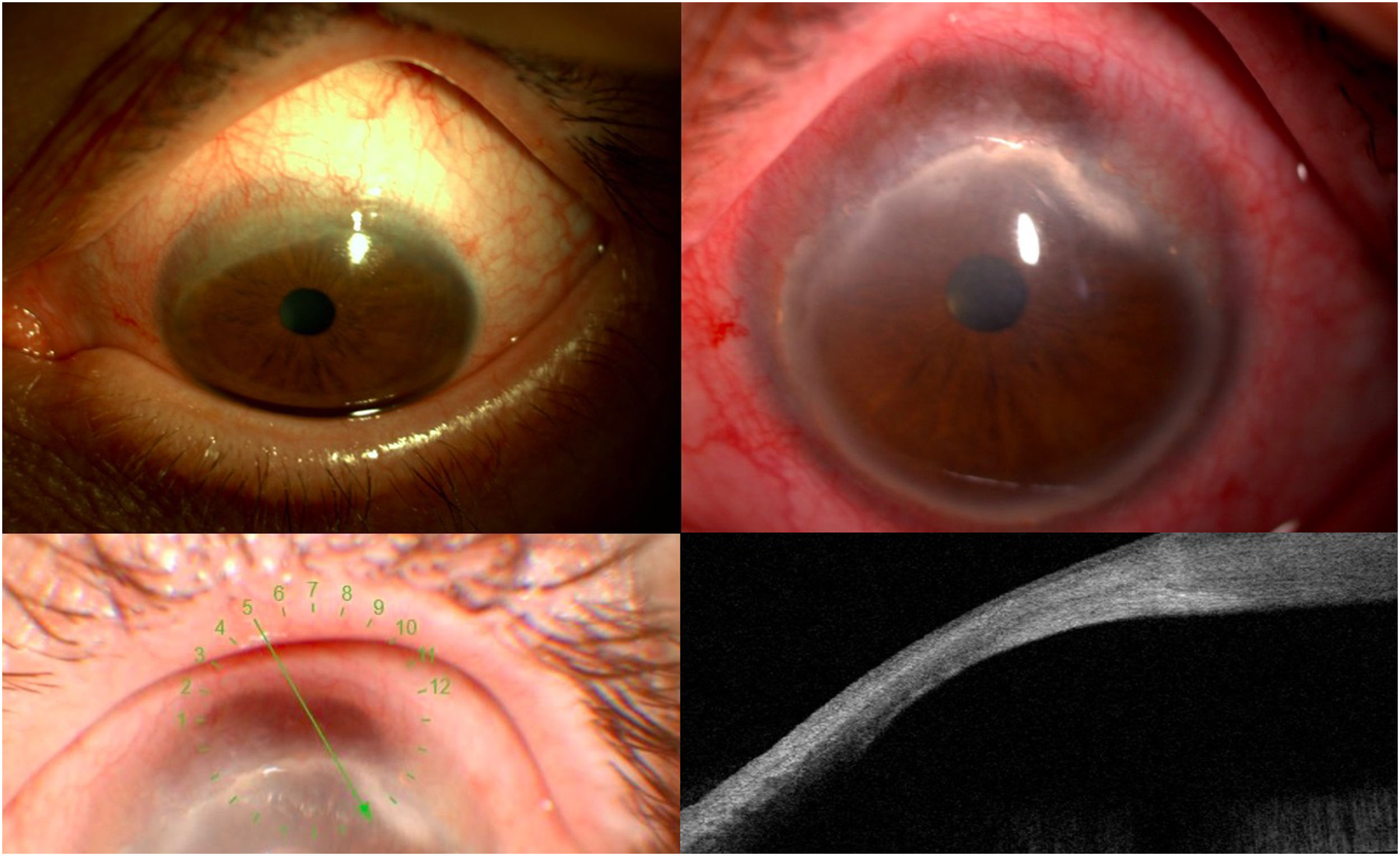 Evolución de degeneración marginal de Terrien a lo largo de los años ...
