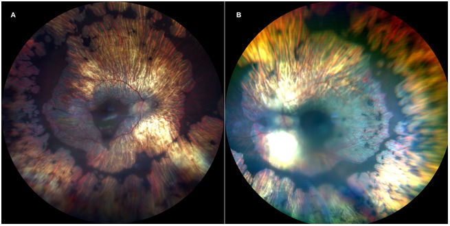 Atrofia girata de la coroides y la retina: actualización en diagnóstico ...