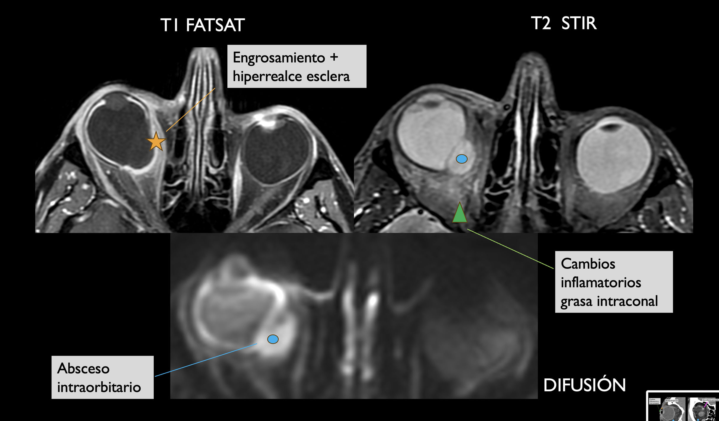 Endoftalmitis atípica por Streptococcus pneumoniae | Archivos de la ...