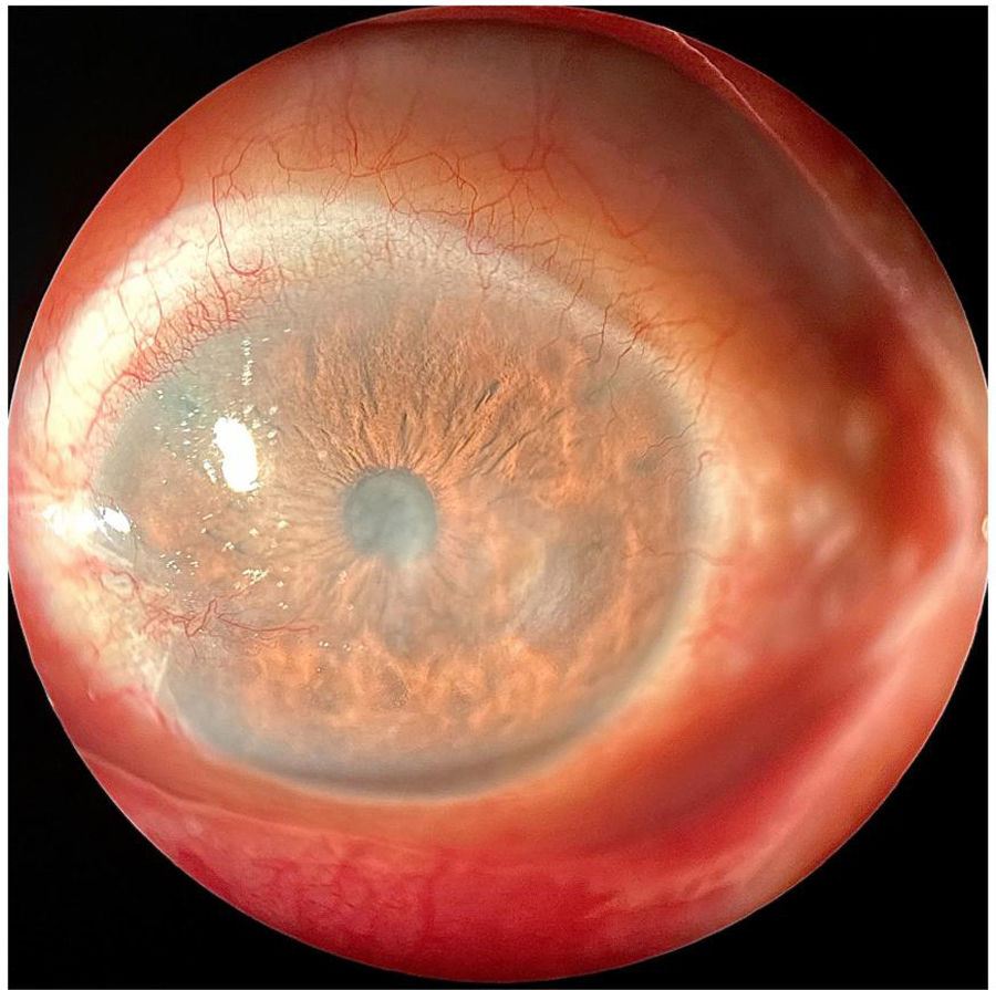Tratamiento con losartán para la rehabilitación visual post queratitis ...