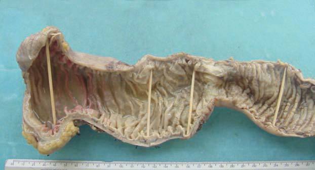 Duplicación colónica. Informe de un caso y revisión de la literatura ...