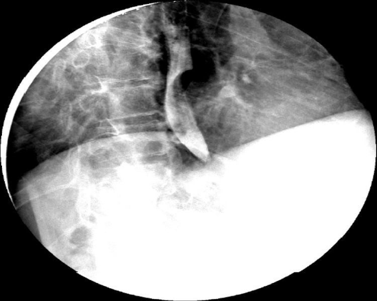 Quiste de duplicación esofágica: un hallazgo poco común | Revista de ...