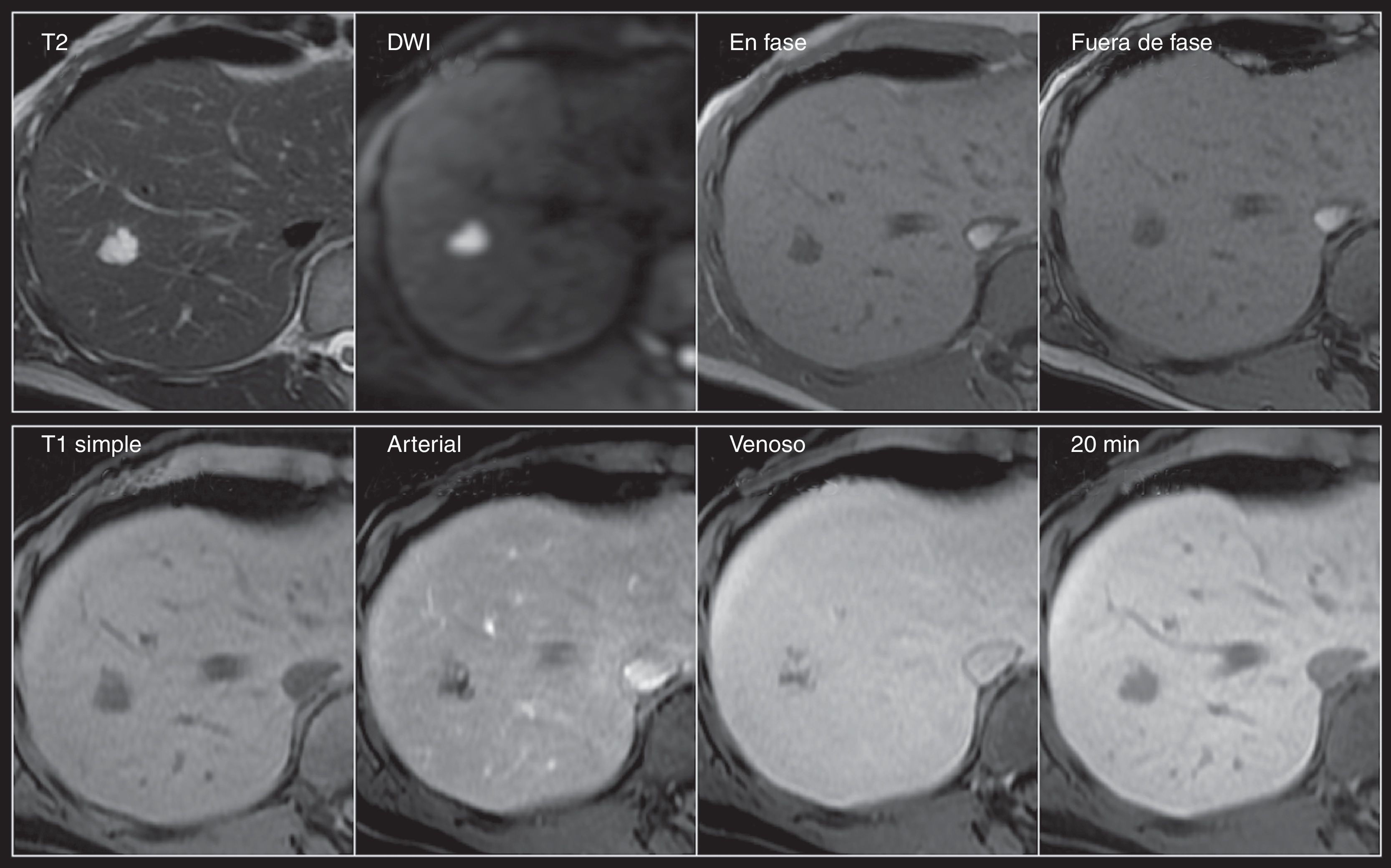 Resonancia magnética con ácido gadoxético —contraste hepatoespecífico ...