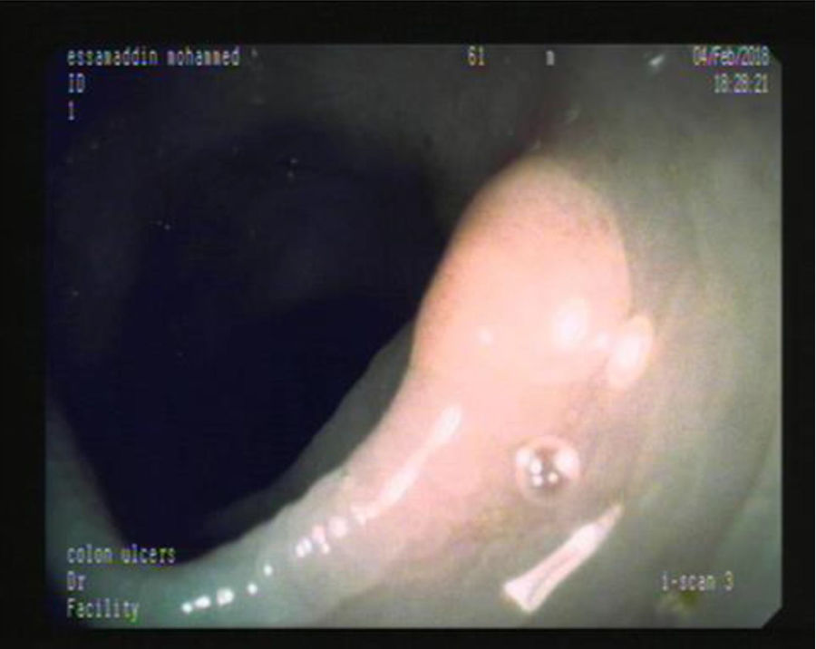 Técnicas colonoscópicas para la detección de pólipos: un estudio ...