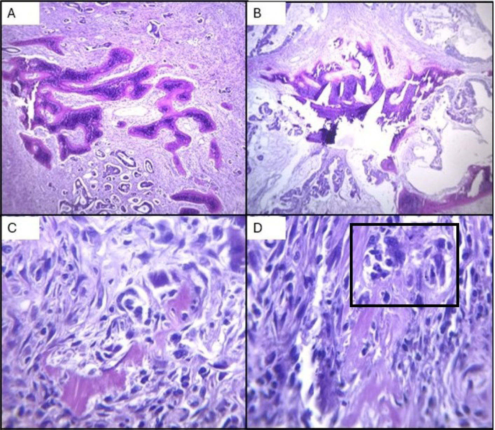 Obstrucción intestinal y metástasis hepáticas secundarias a carcinoma ...