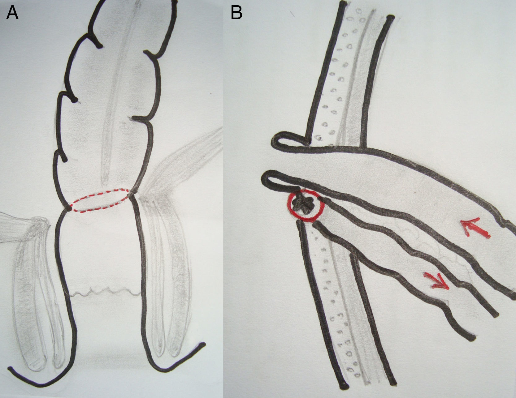 Exenteración pélvica total por cáncer primario del recto: resultados ...