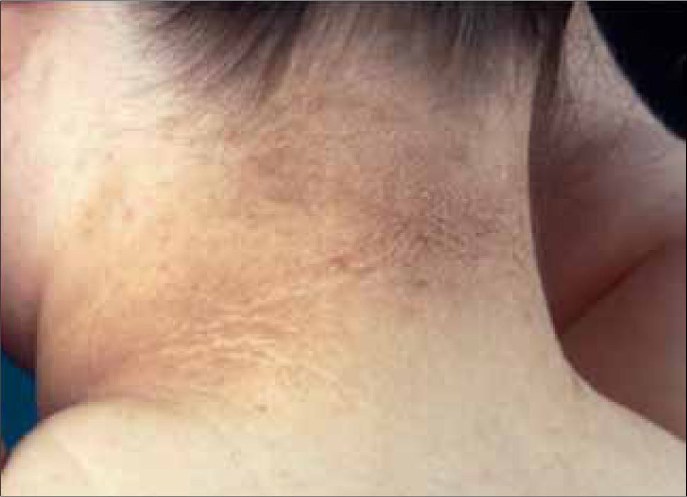 escoriaciones multiples