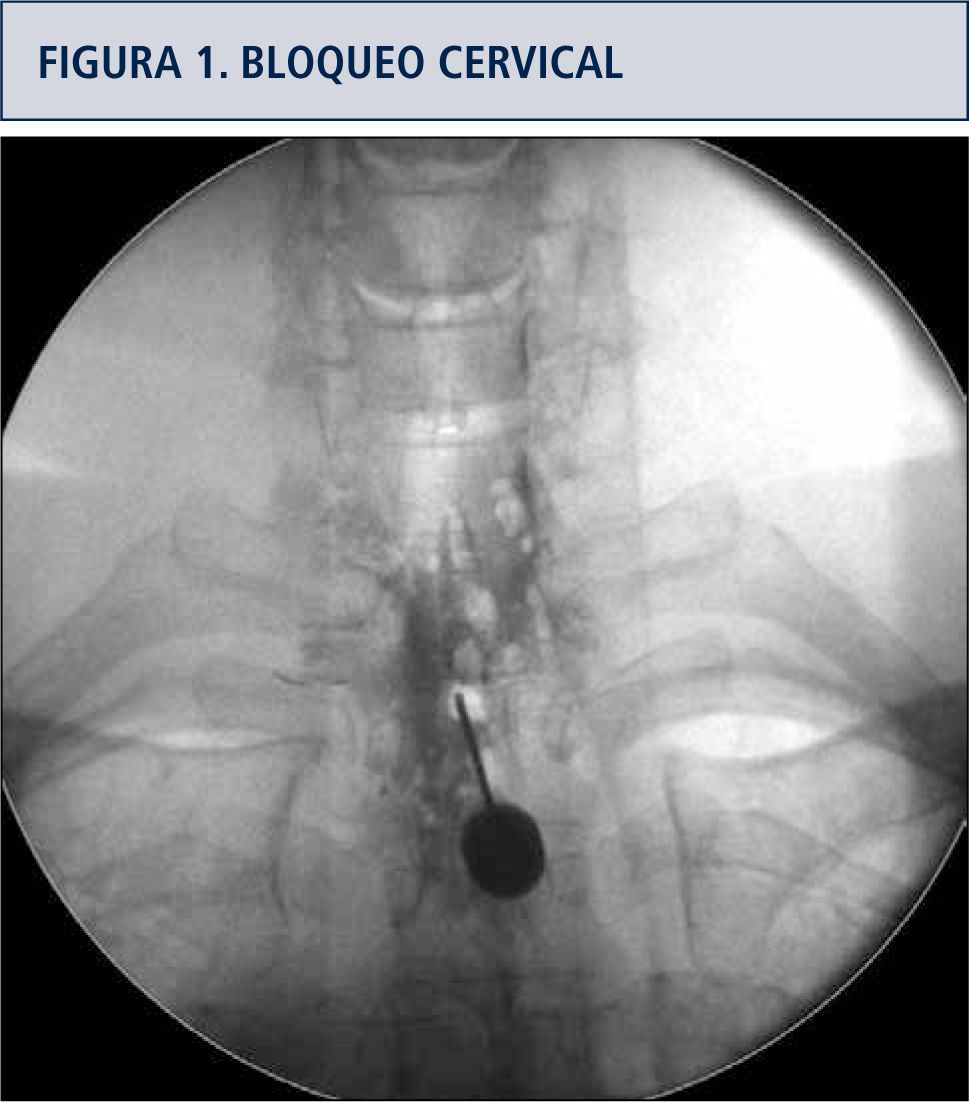 Evaluación y manejo del dolor cervical facetario | Revista Médica ...