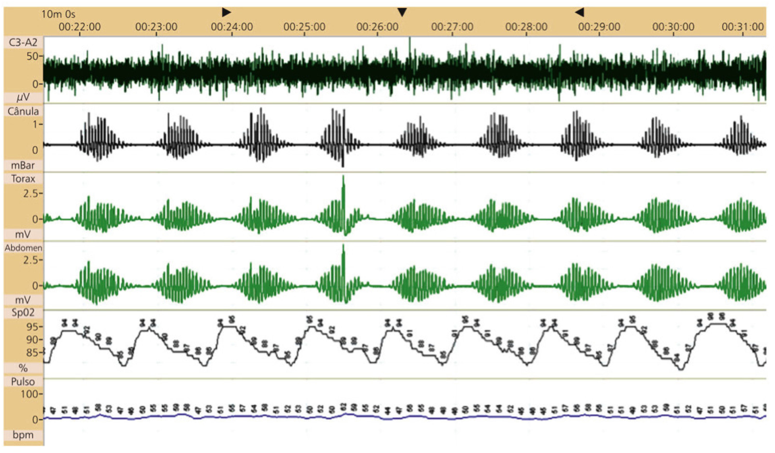 Síndrome de apnea obstructiva del sueño y sus consecuencias ...