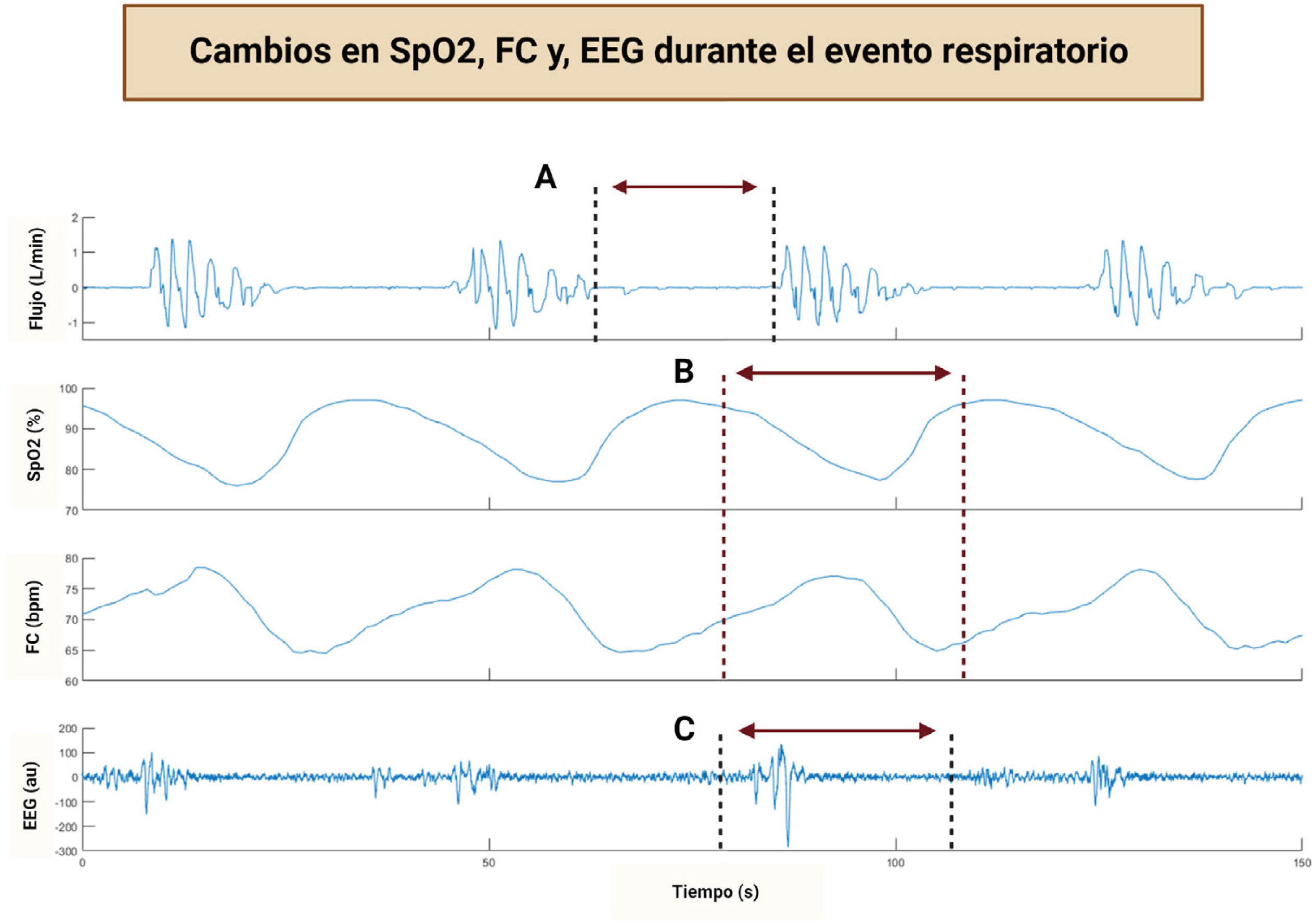 Cómo calificar el índice de gravedad en la apnea obstructiva del sueño ...