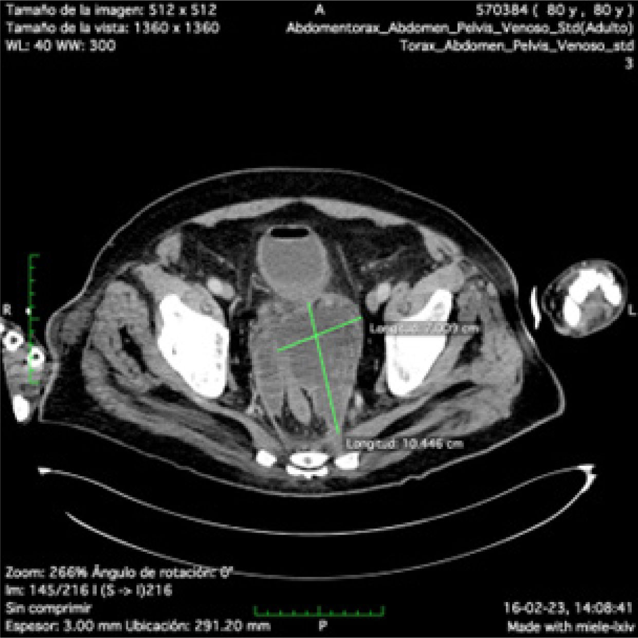 BCGitis: Absceso pélvico por Mycobacterium bovis BCG posterior a ...