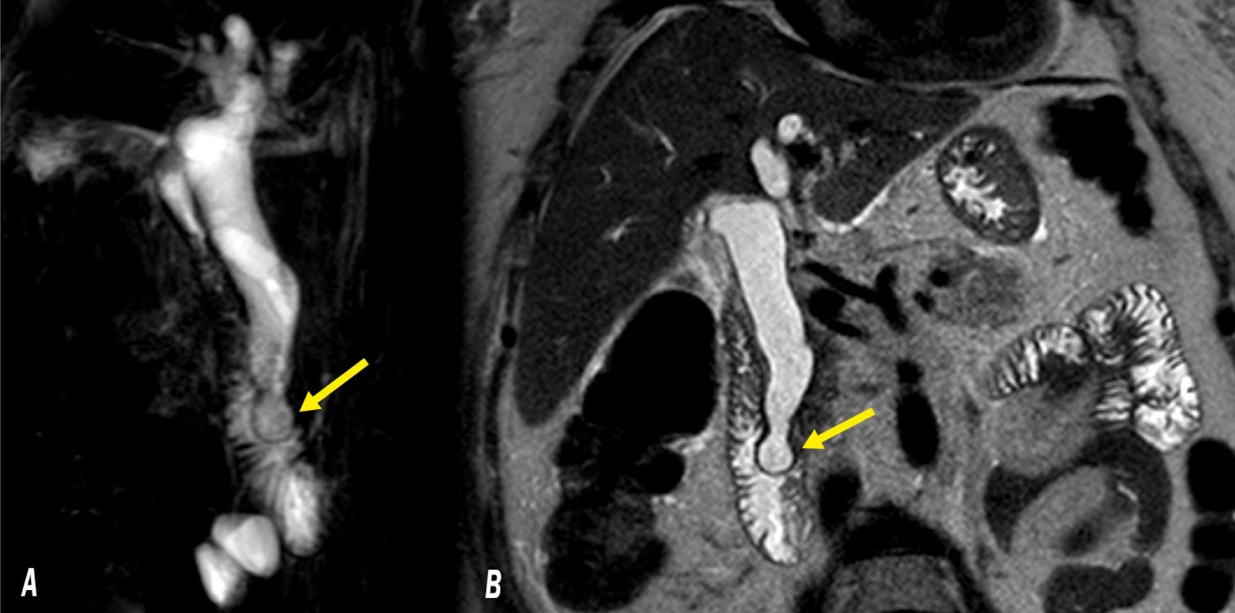 Coledococele en adulto mayor: una causa inusual de pancreatitis aguda a ...