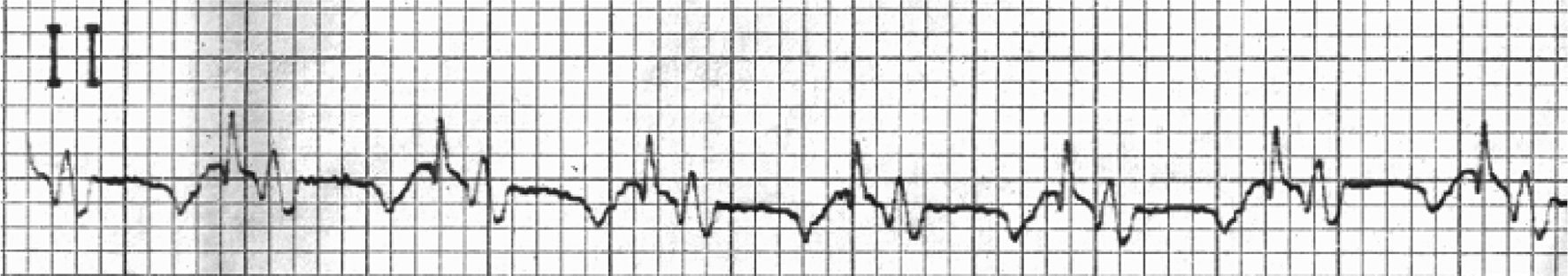 A rhythm by two players: ECG tracing found in conjoined twins | Revista ...
