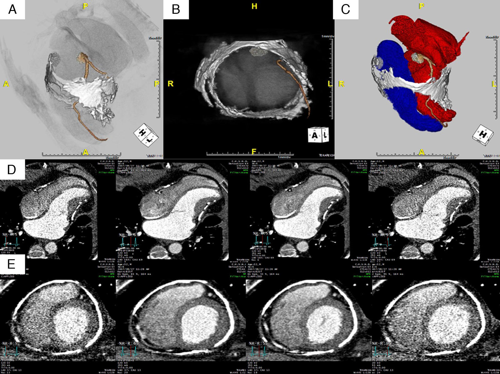 constrictive pericarditis mri