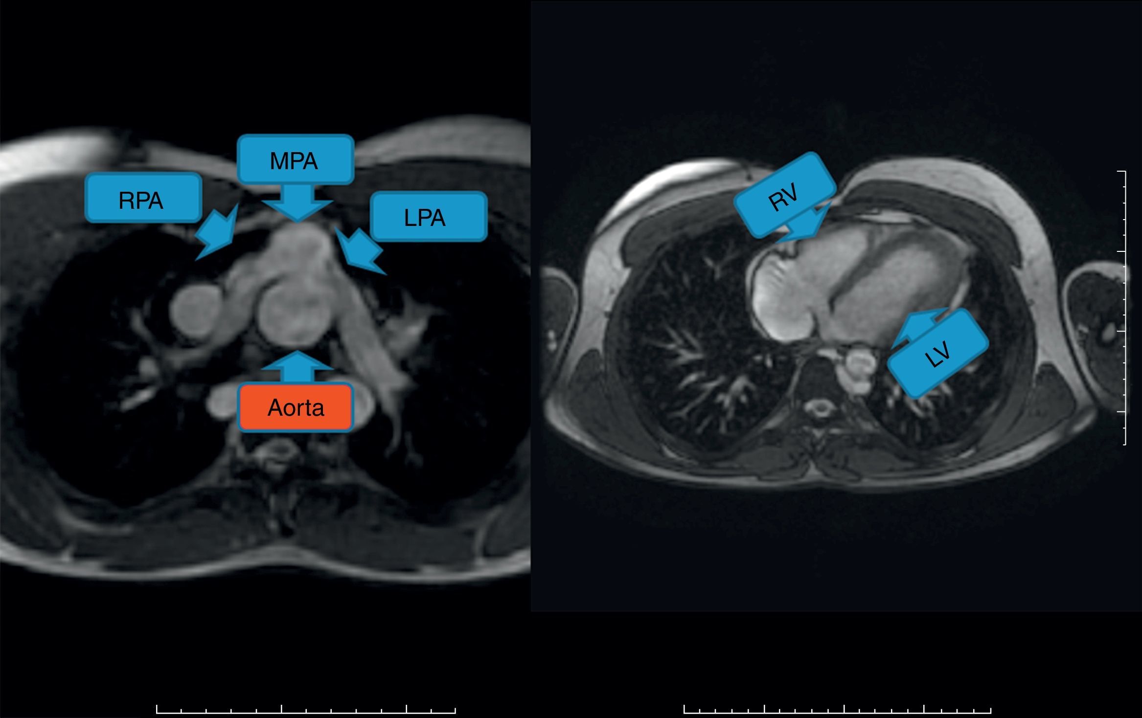 Three different surgical approaches for transposition of the great ...