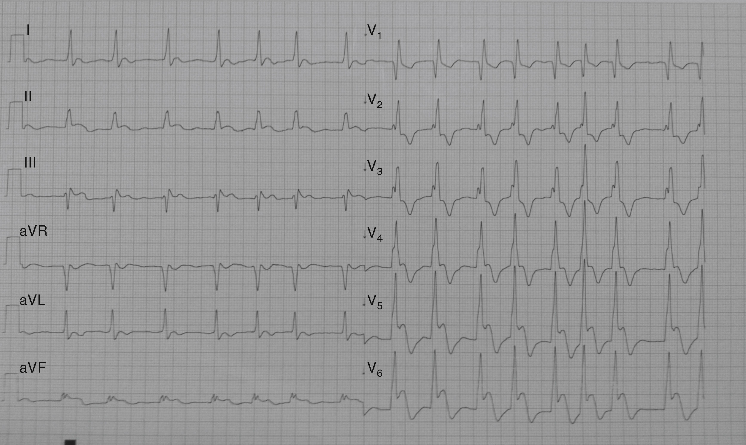 st segment changes in ecg