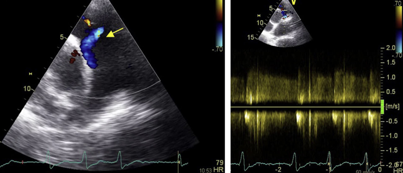 O Ecocardiograma Transtor cico No Diagn stico De Uma F stula Coron ria O Ecocardiograma Transtor cico No Diagn stico De Uma F stula Coron ria