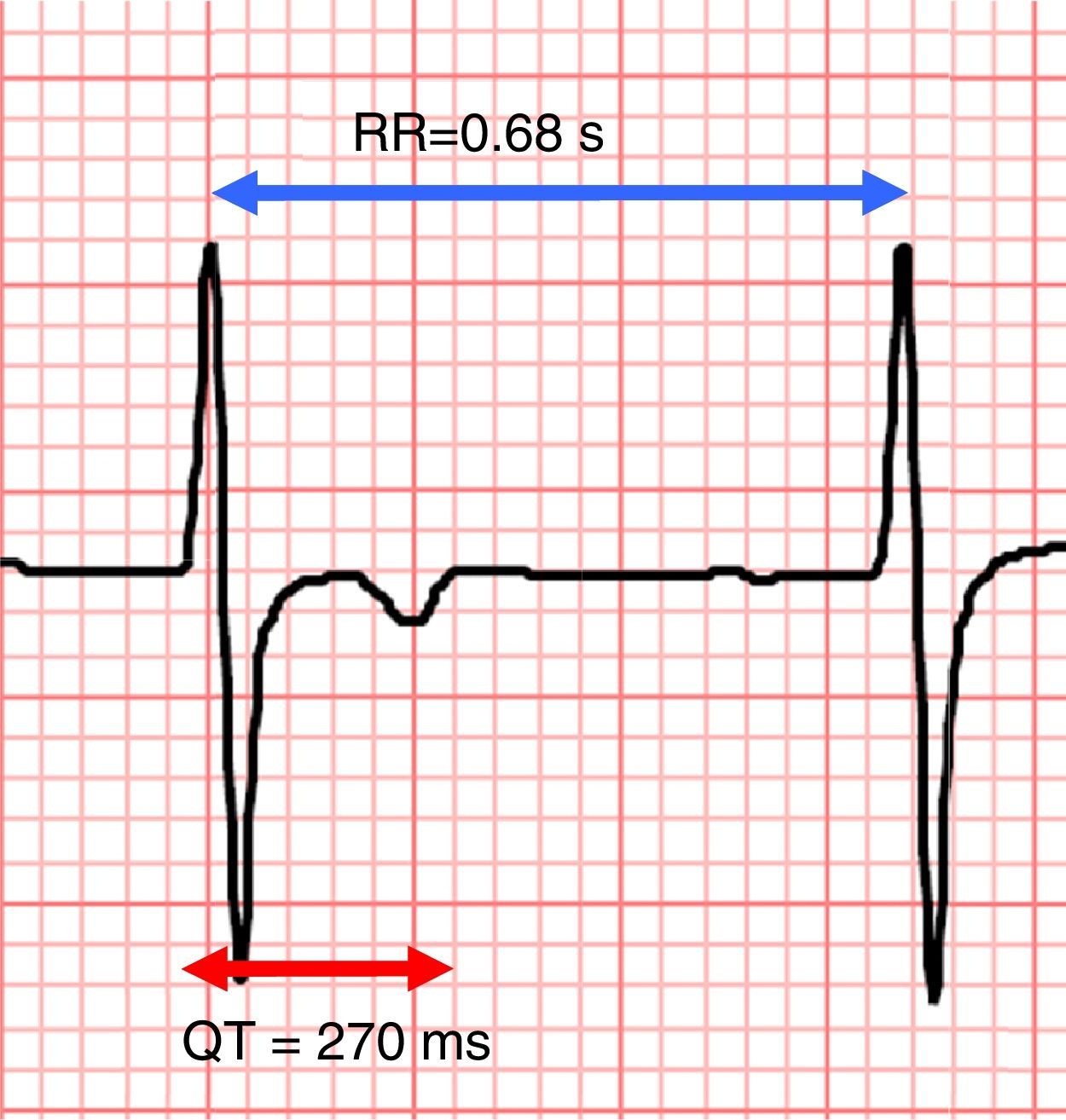 Short QT syndrome presenting as syncope: How short is too short ...