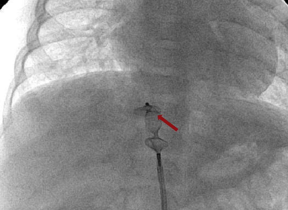 Major aortopulmonary collateral artery (MAPCA) gigante – causa rara de ...