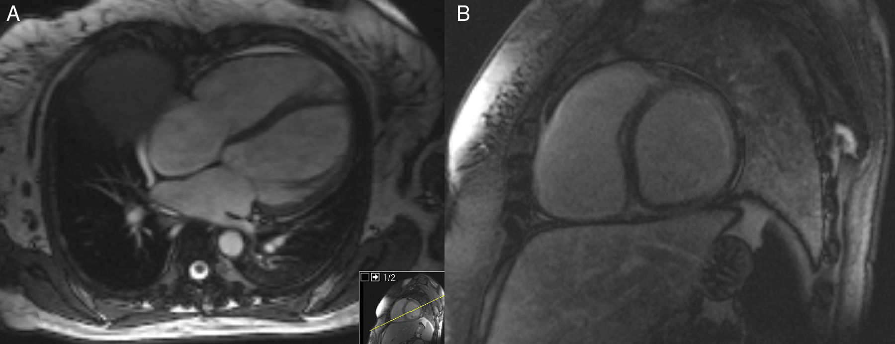 Systemic sclerosis: A rare cause of heart failure? | Revista Portuguesa ...