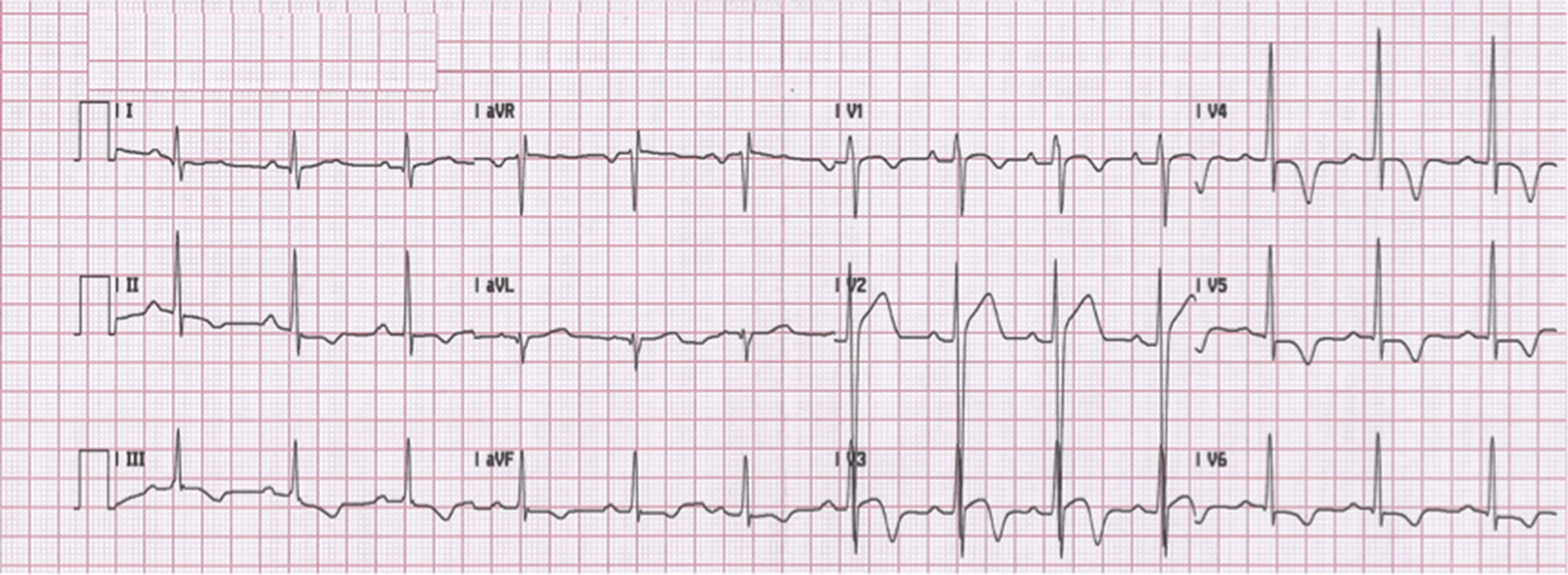 ecg changes with ethnicity