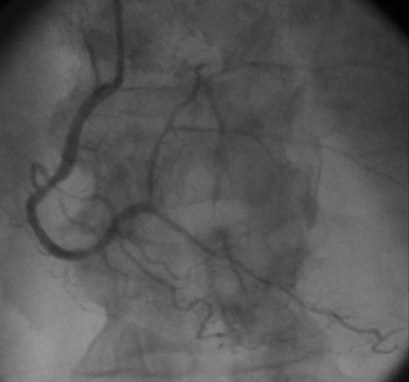 Inferior wall acute myocardial infarction or something else? | Revista ...