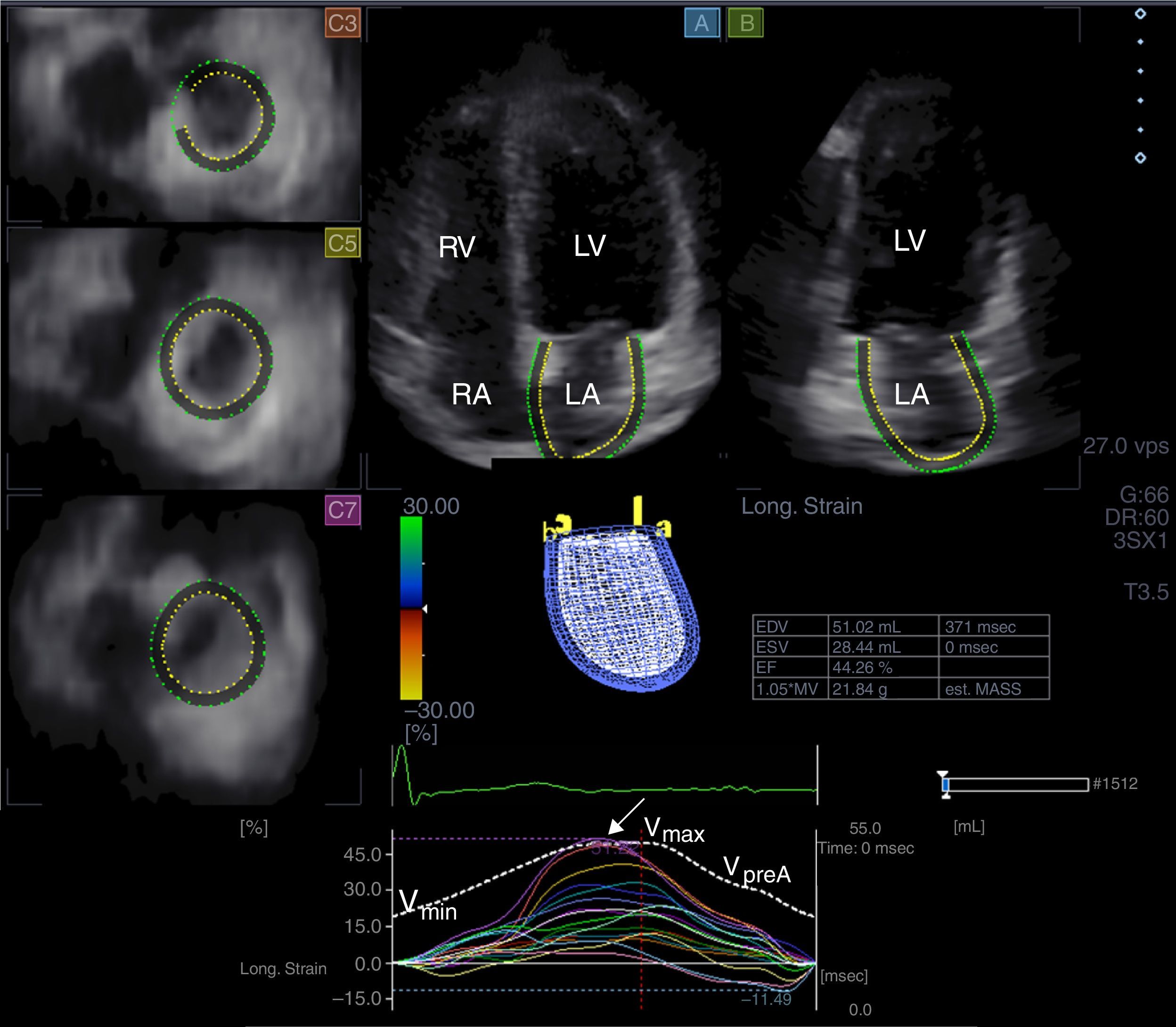 Characterization of left atrial dysfunction in hypereosinophilic ...