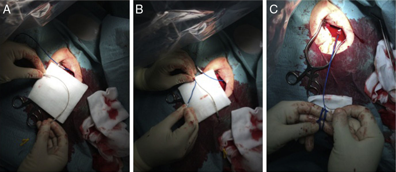 Active fixation coronary sinus lead extraction – A safe procedure ...