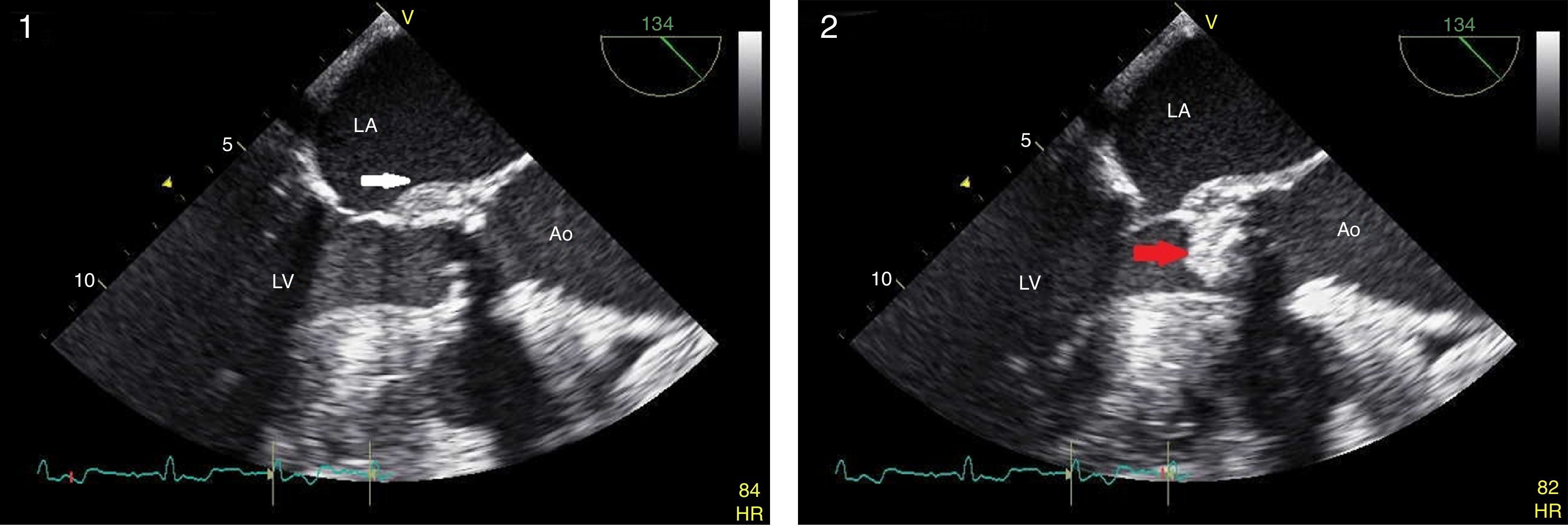 infective endocarditis echo