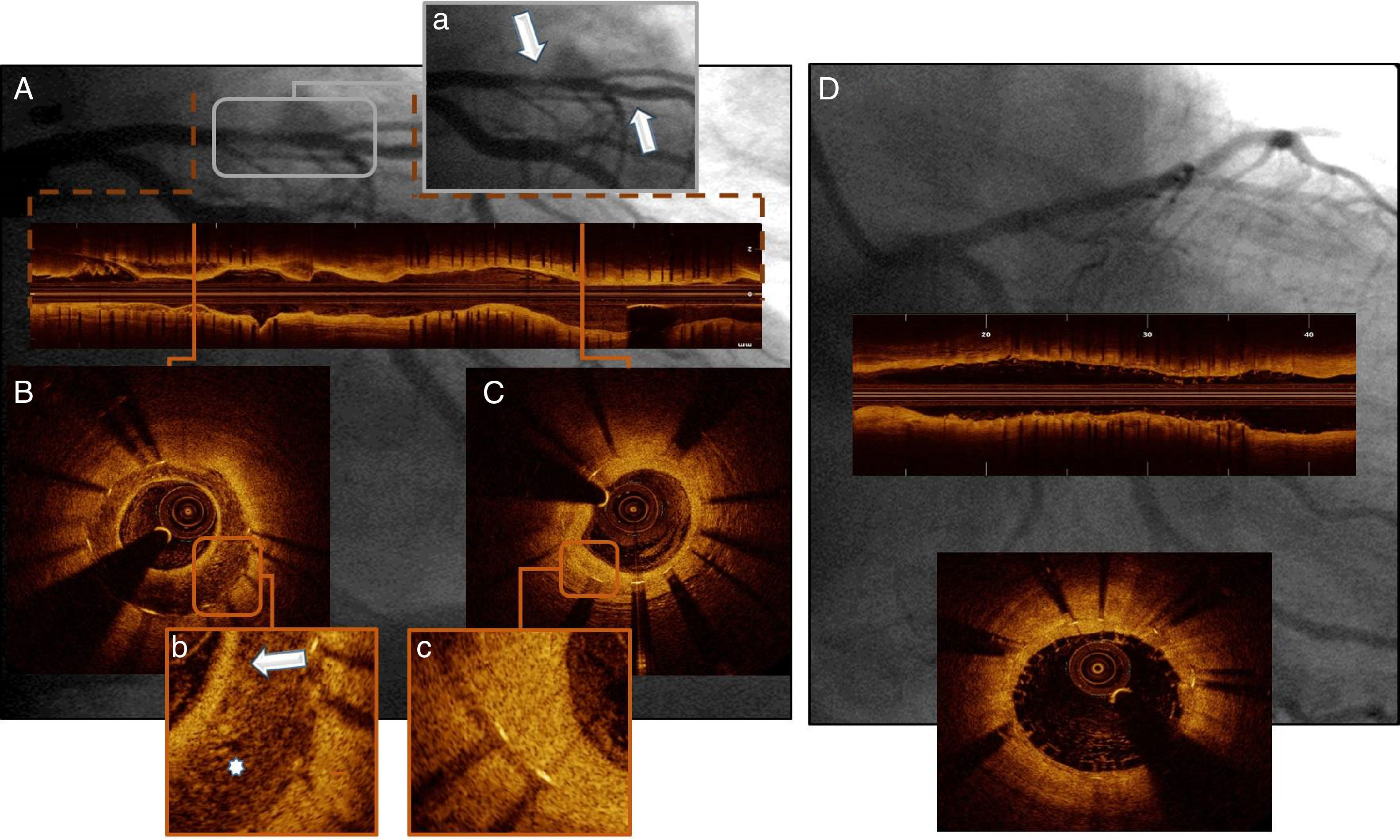 Different patterns of in-stent coverage in drug-eluting stents ...