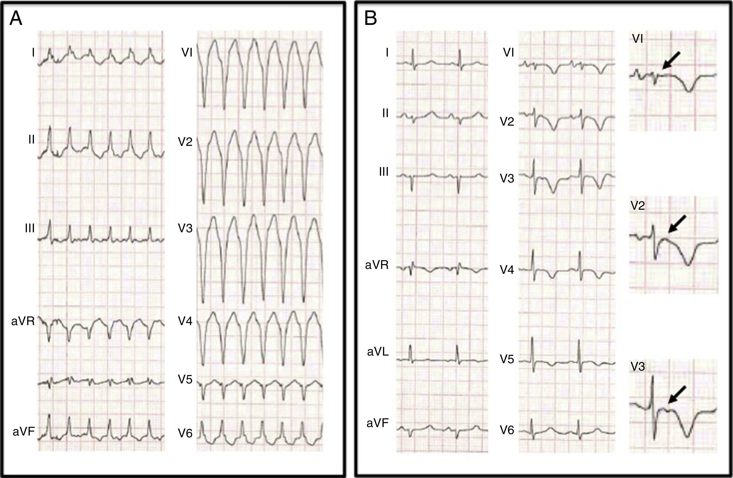 vtach ecg tracing