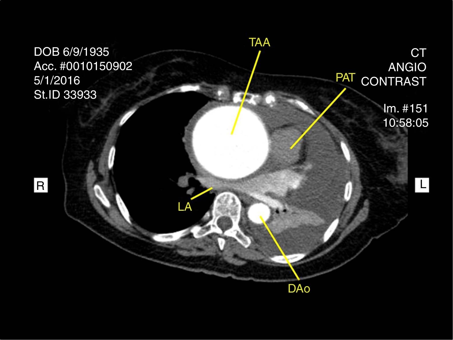 thoracic aorta scan