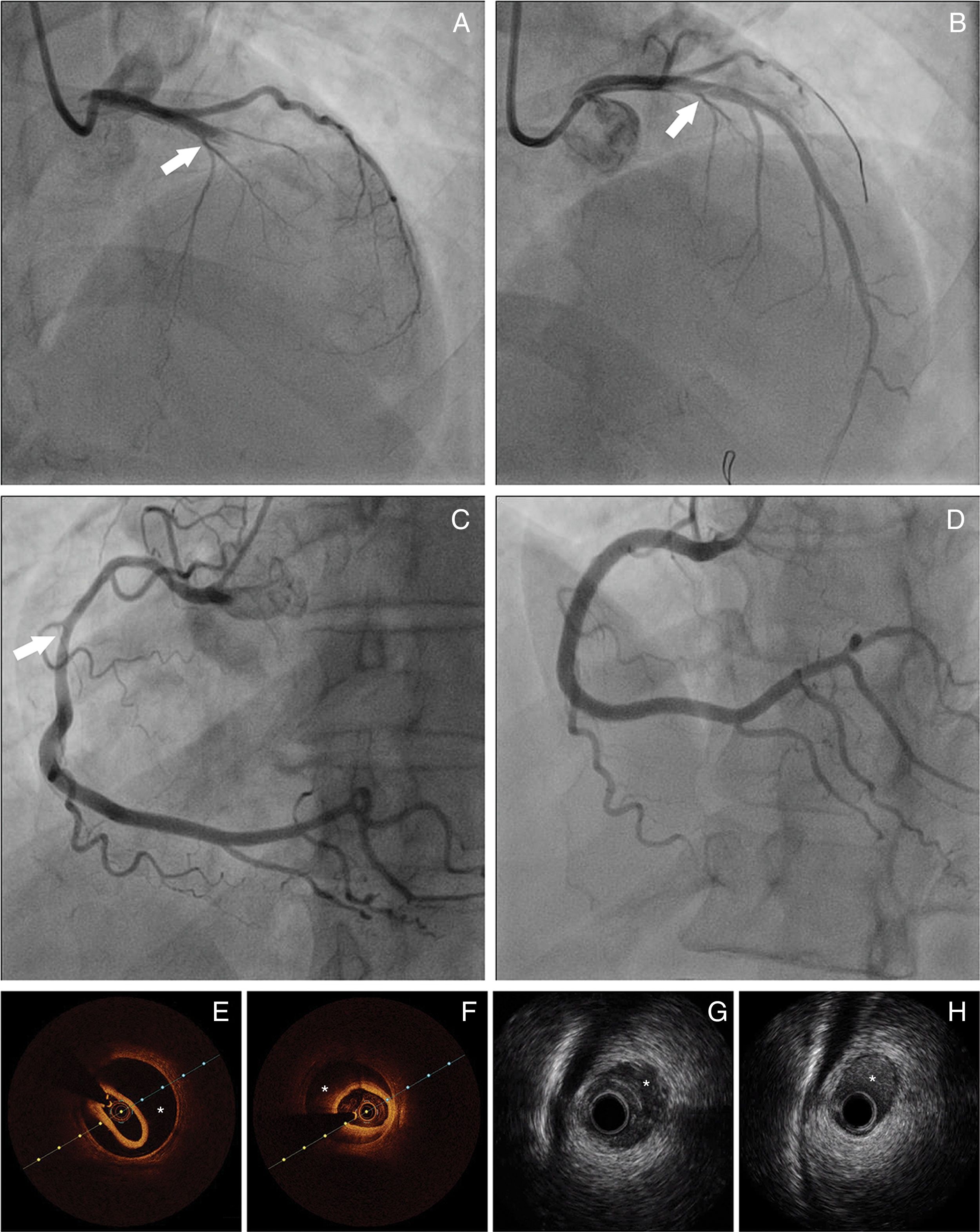 Spontaneous coronary artery dissection: A single-center case series and ...
