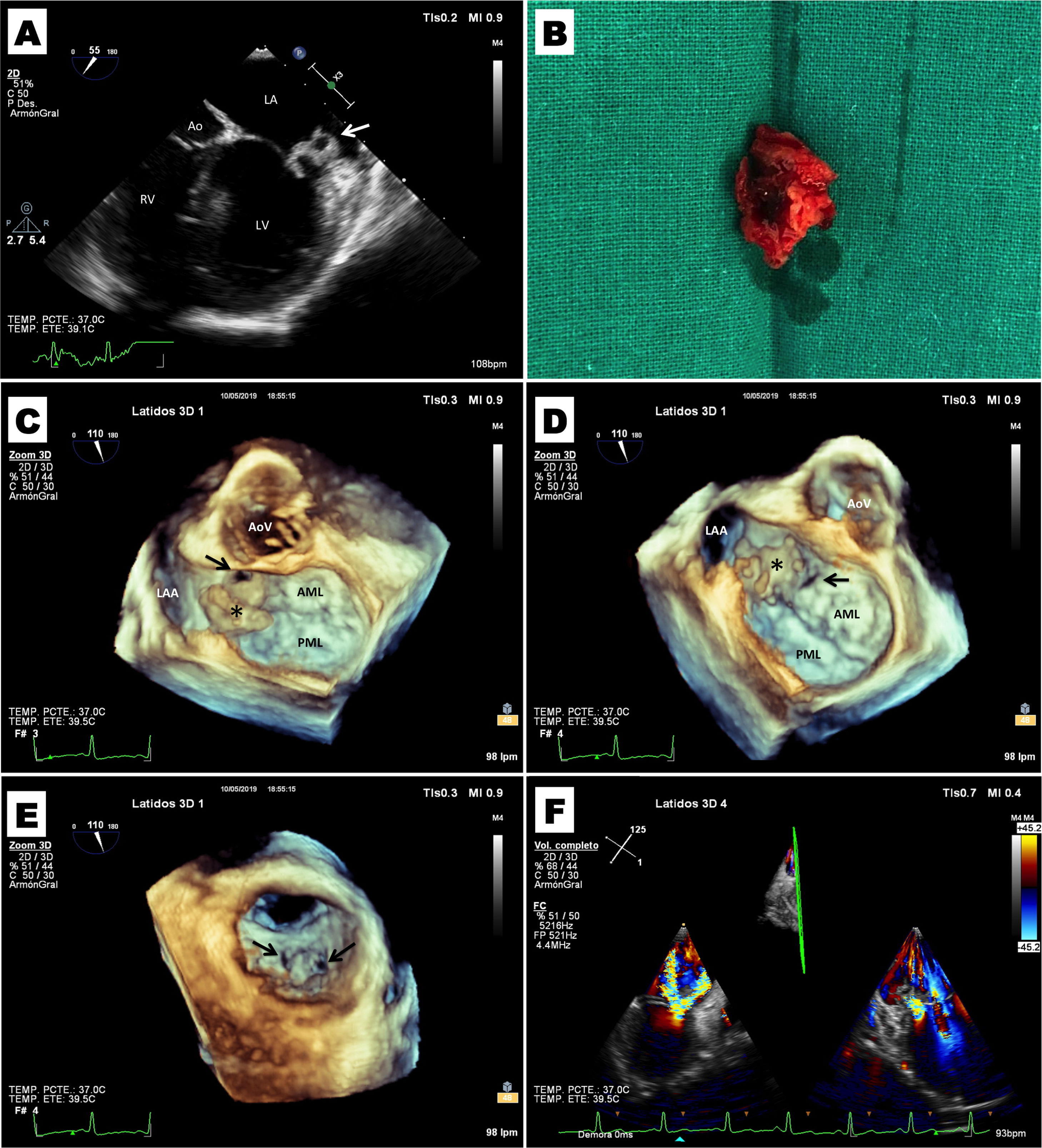 mitral valve leaflets tee