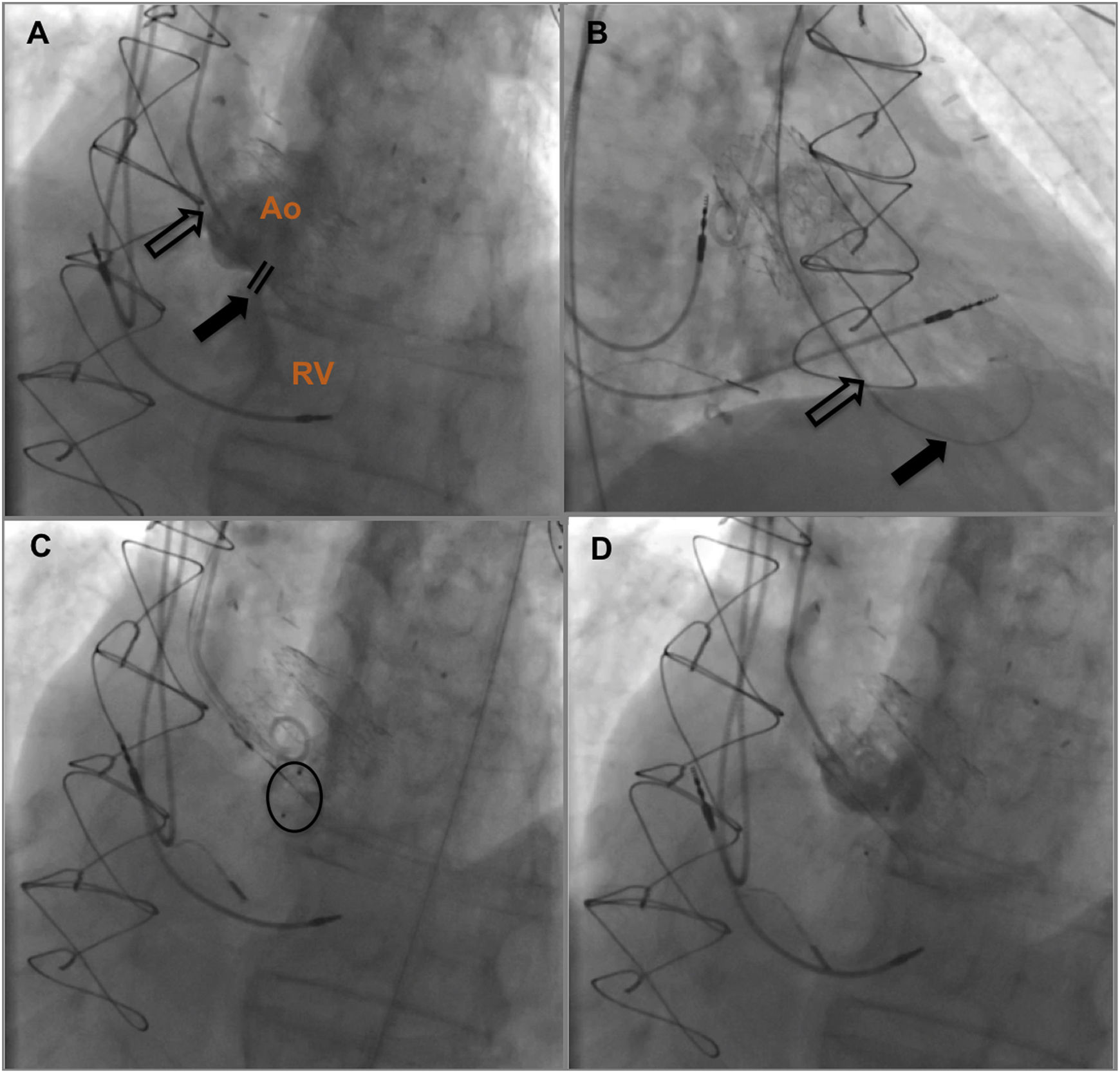 Aortic annulus rupture with fistula to the right ventricle following ...