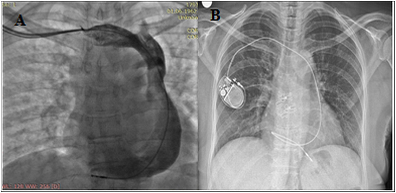Placement of permanent pacemaker in a patient with venous anomaly ...