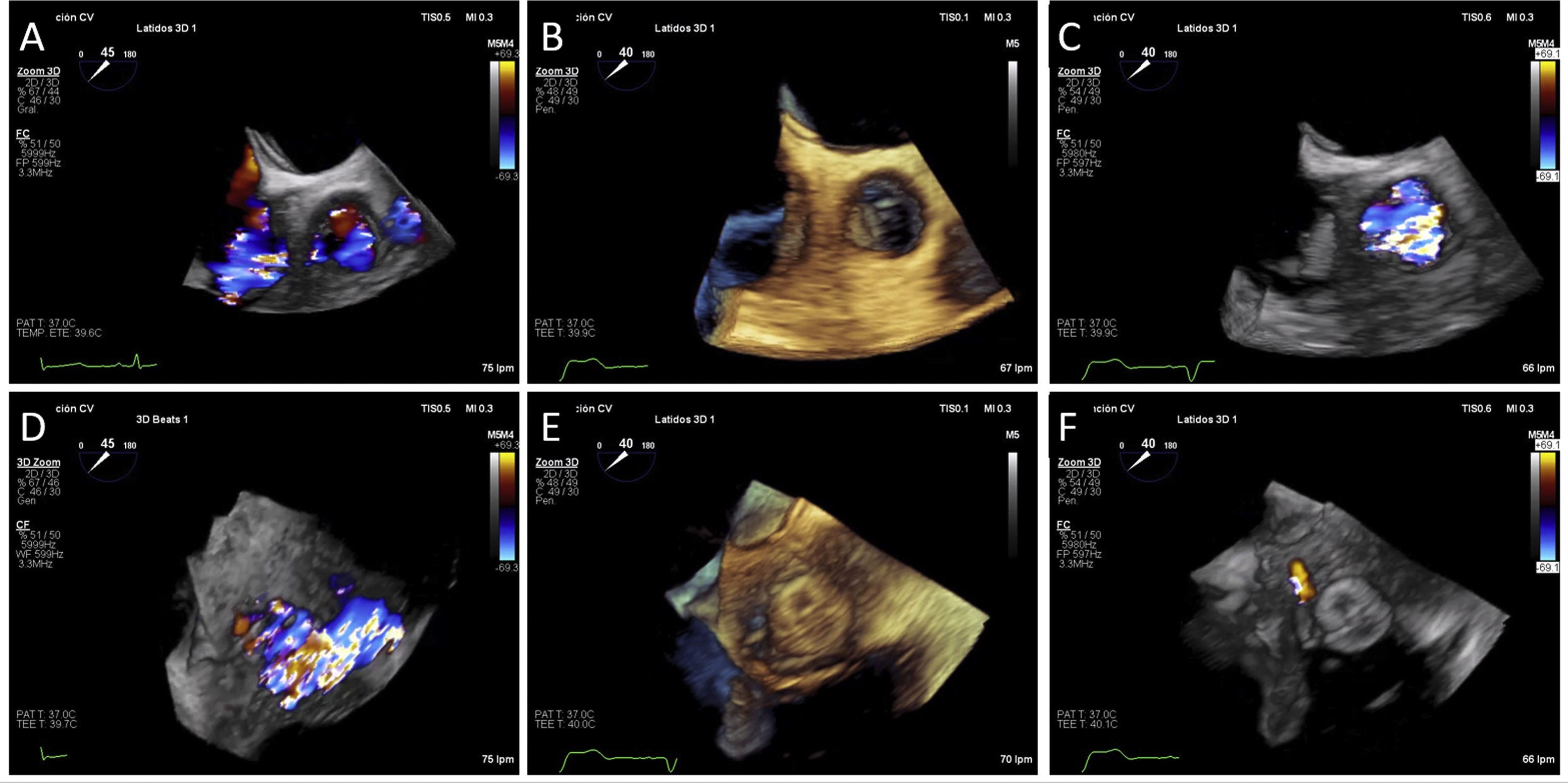 Right aortic sinus-to-right atrium fistula: Multimodality imaging and ...