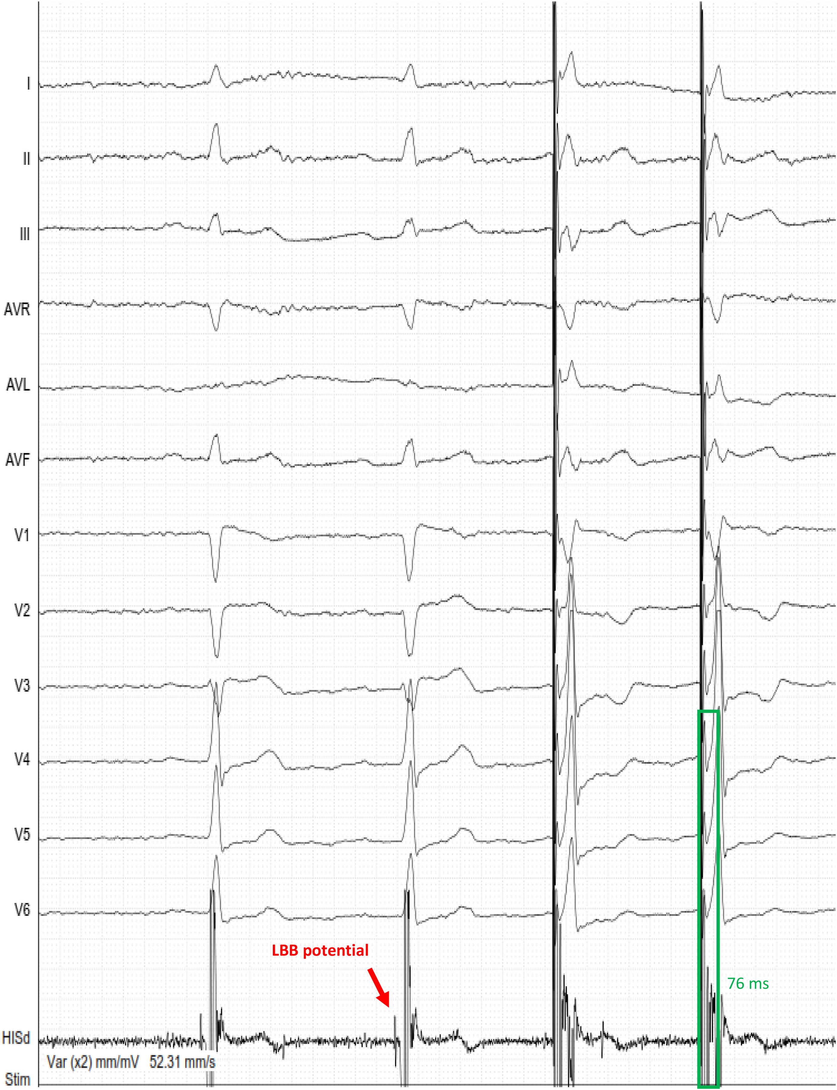 His bundle pacing and left bundle branch area pacing: Feasibility and ...