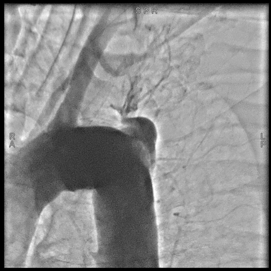 A holy situation: An unexpected complication during a transcatheter ...